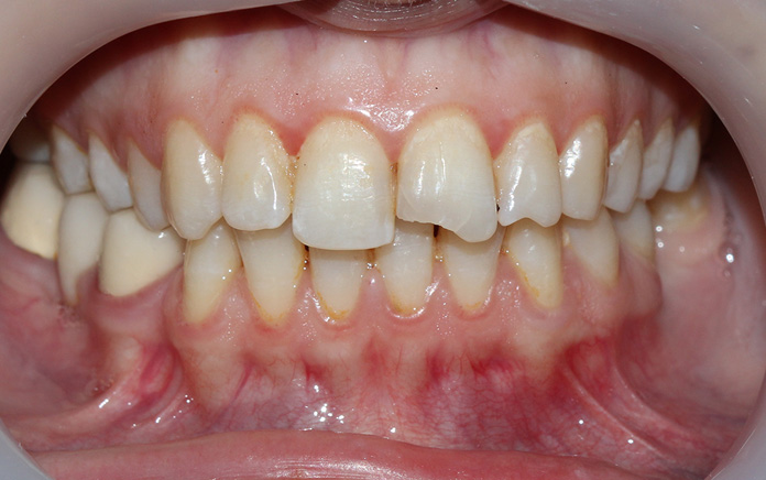 Aesthetic Fillings - Dr Abeer Ammouri Clinic